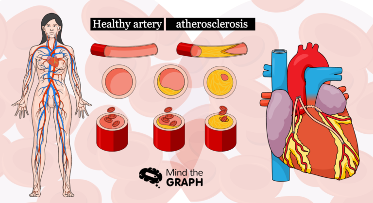 Understanding atherosclerosis through medical illustrations - Mind the ...