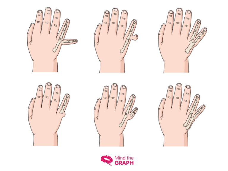 Polydactyly: Understanding the Condition