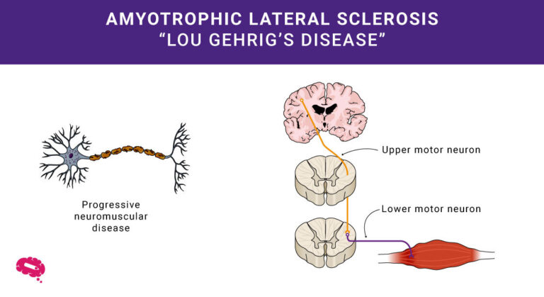 Apa itu Sklerosis Lateral Amyotrophic dan Efeknya? - Blog Mind the Graph